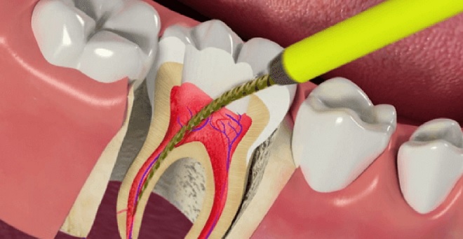 ️Harga Perawatan Saluran Akar Gigi Terbaru November 2024 dan Manfaat ...